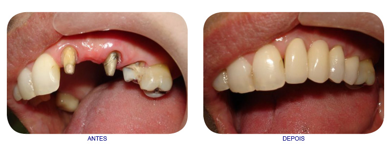 Faça Sua Prótese Dental | Brunherotto Odontologia Estética Jundiaí
